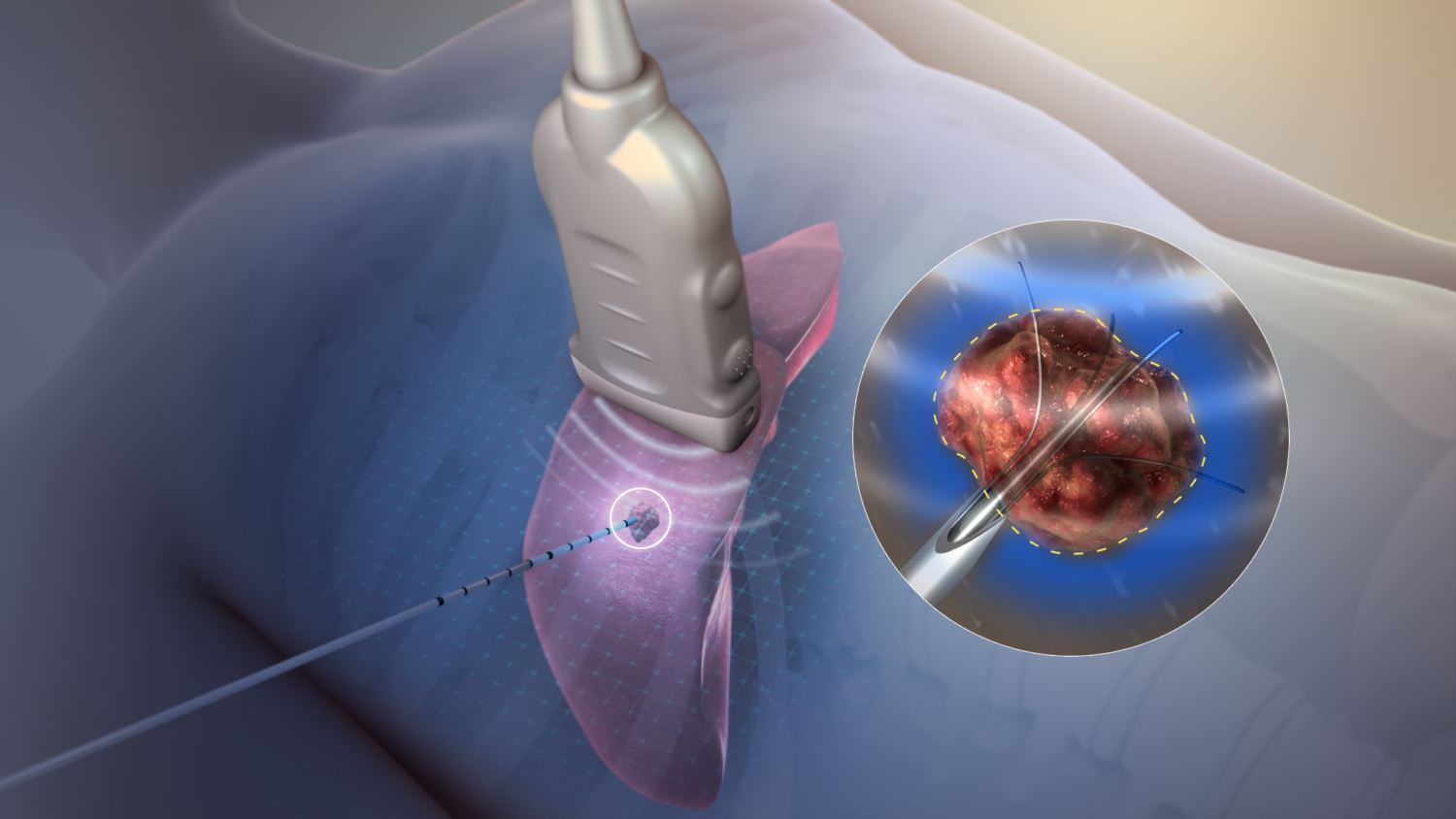 Radiofrequency_ablation - The Hip & Knee Clinic